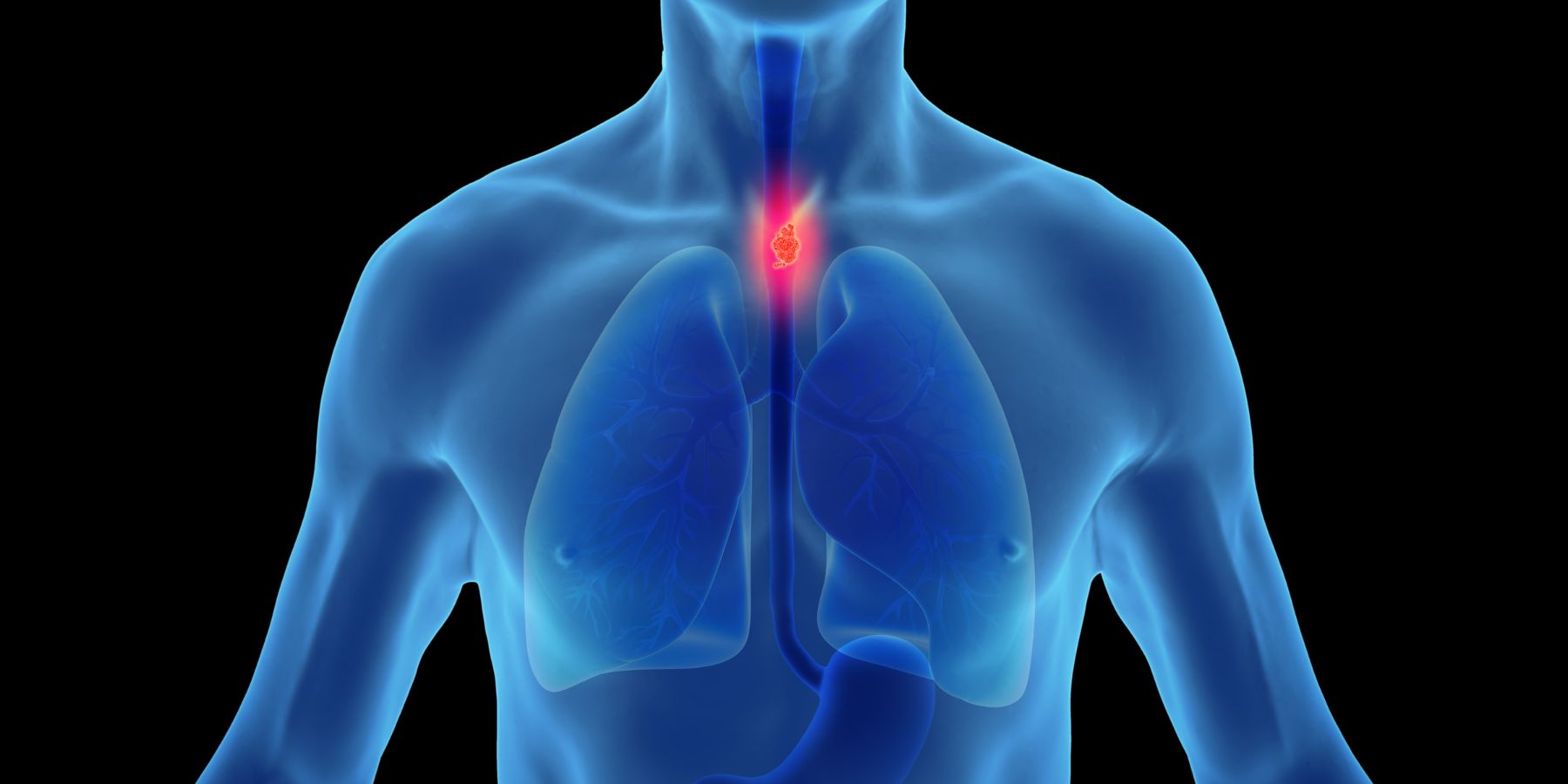 ¿Cómo Aliviar el Dolor de Garganta por Faringitis en Casa ...